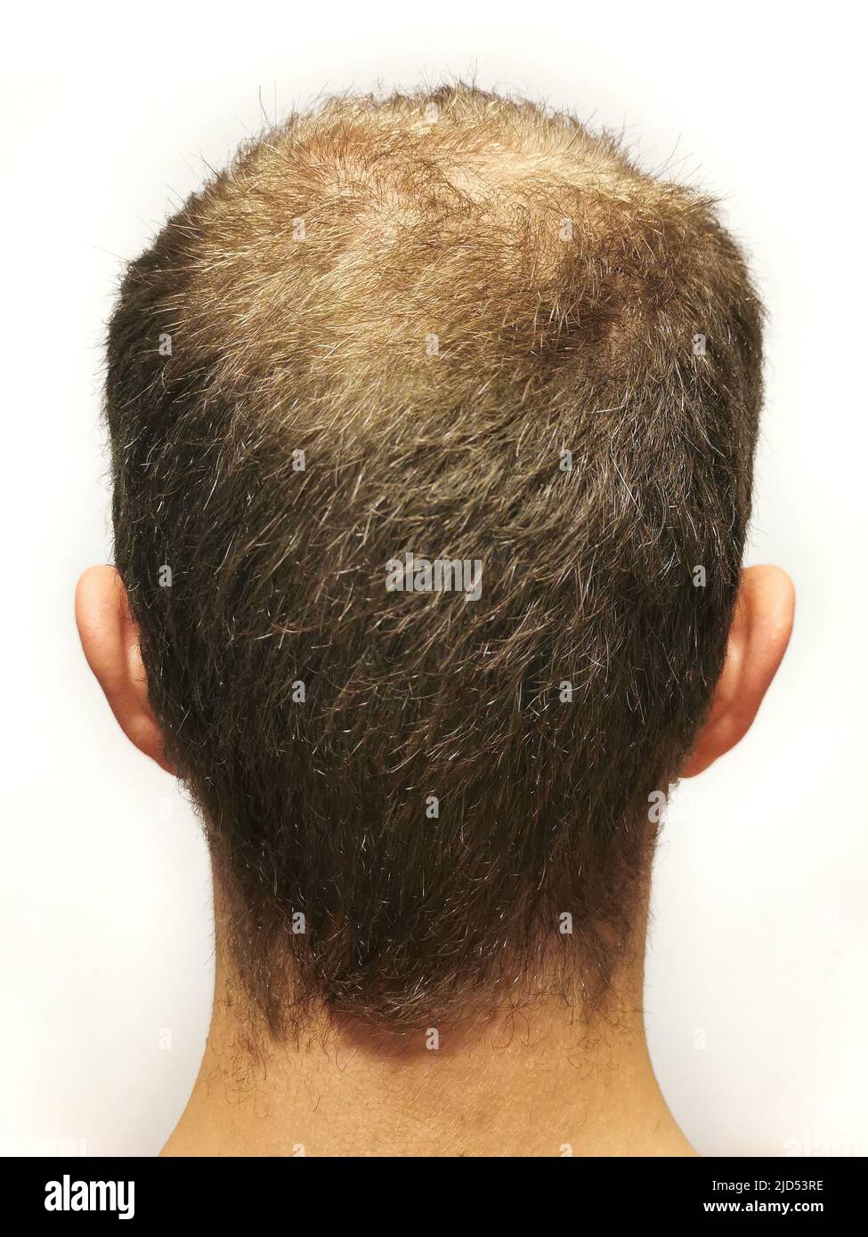 Hair loss beauty hi-res stock photography and images - Alamy