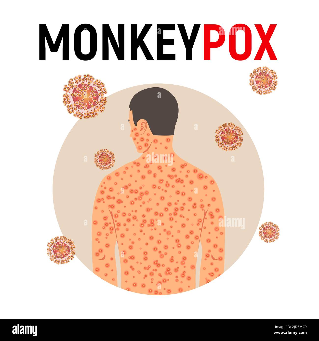 Man sick with monkey smallpox in flat style isolated on white ...