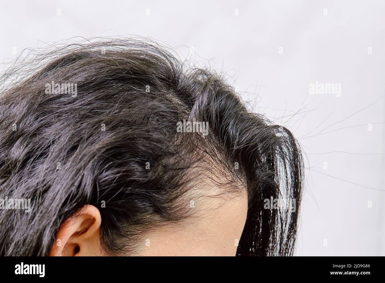 Female hairloss. Sad young woman with hair loss problem. Hair Loss ...