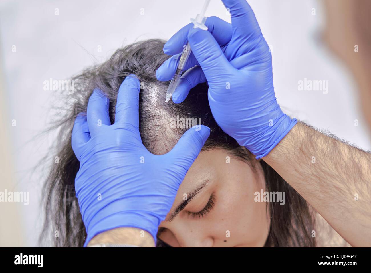 treatment of hair loss, injection for hair growth. Injected in woman's ...