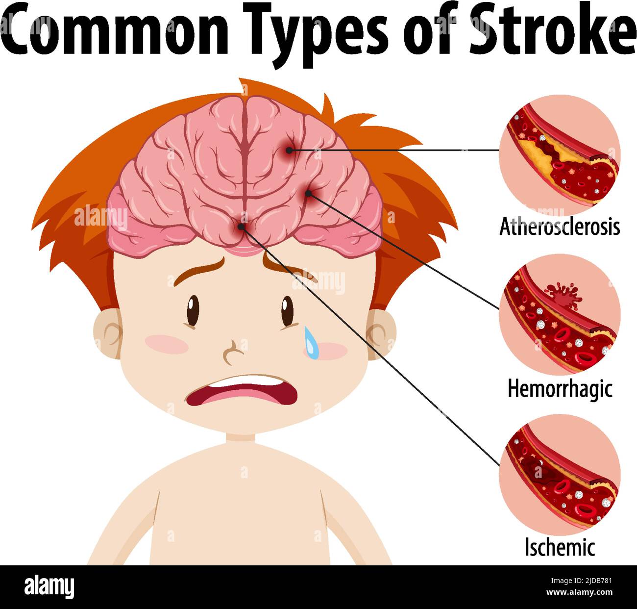 Human with common types of stroke illustration Stock Vector Image & Art ...