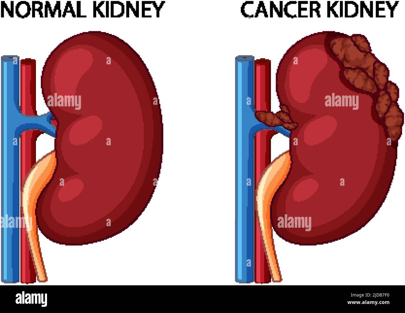 Normal kidney and cancer kidney illustration Stock Vector Image & Art ...