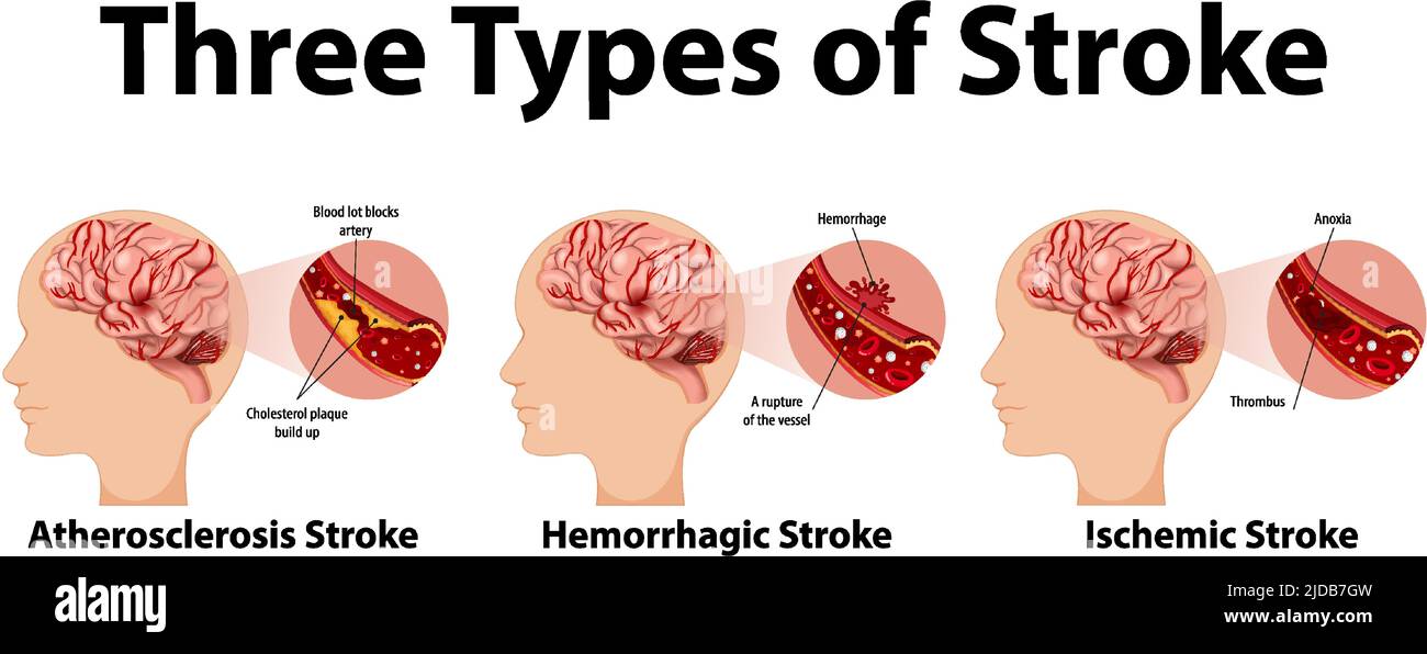 Infographic of common types of stroke illustration Stock Vector Image ...