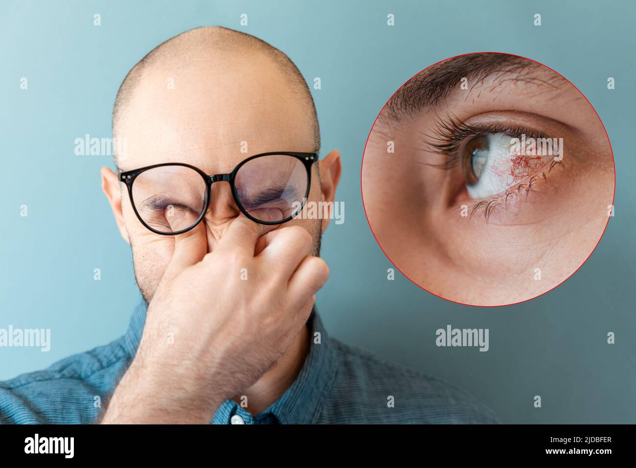 Caucasian bald man lift his glasses and scratches his eyes. Close-up of ...