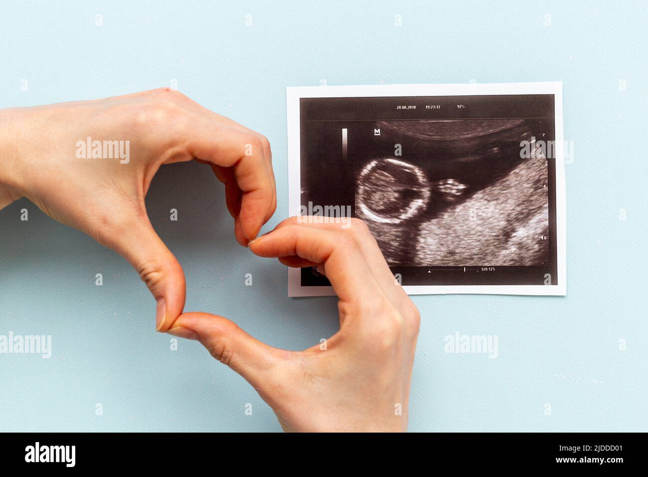 Sonography pregnancy picture of embryo in wonams hands Stock Photo - Alamy