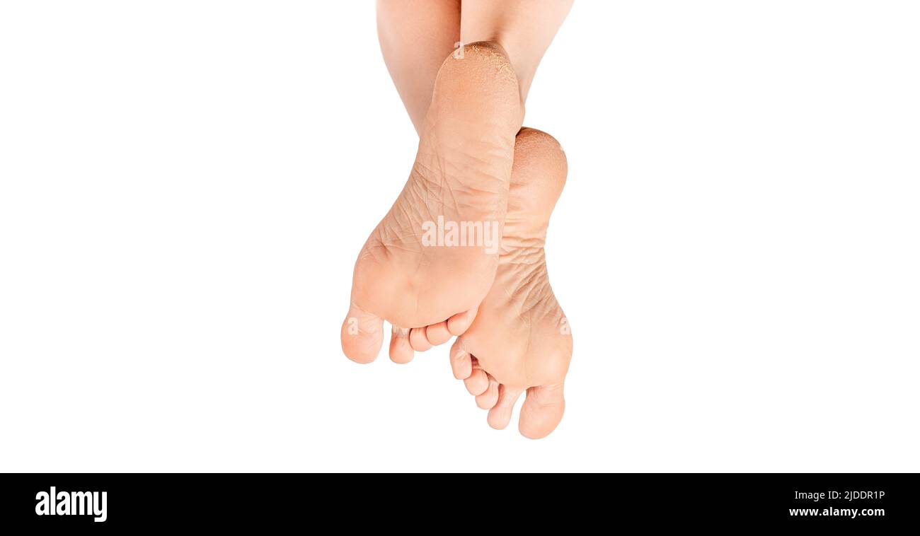 Dry and cracked soles of feet on white background. Dry Female heels ...
