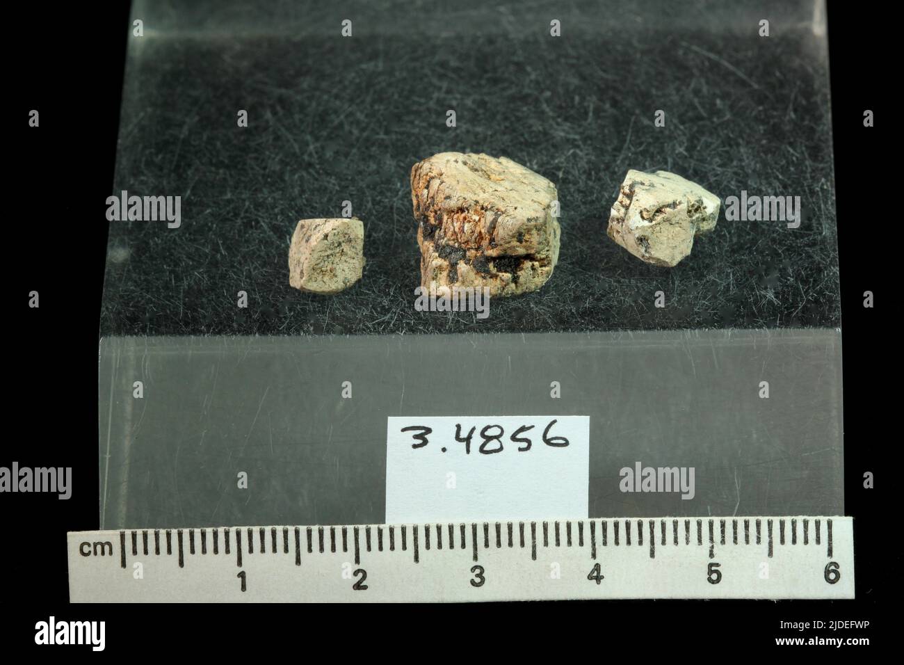 Struvite Kidney Stones
