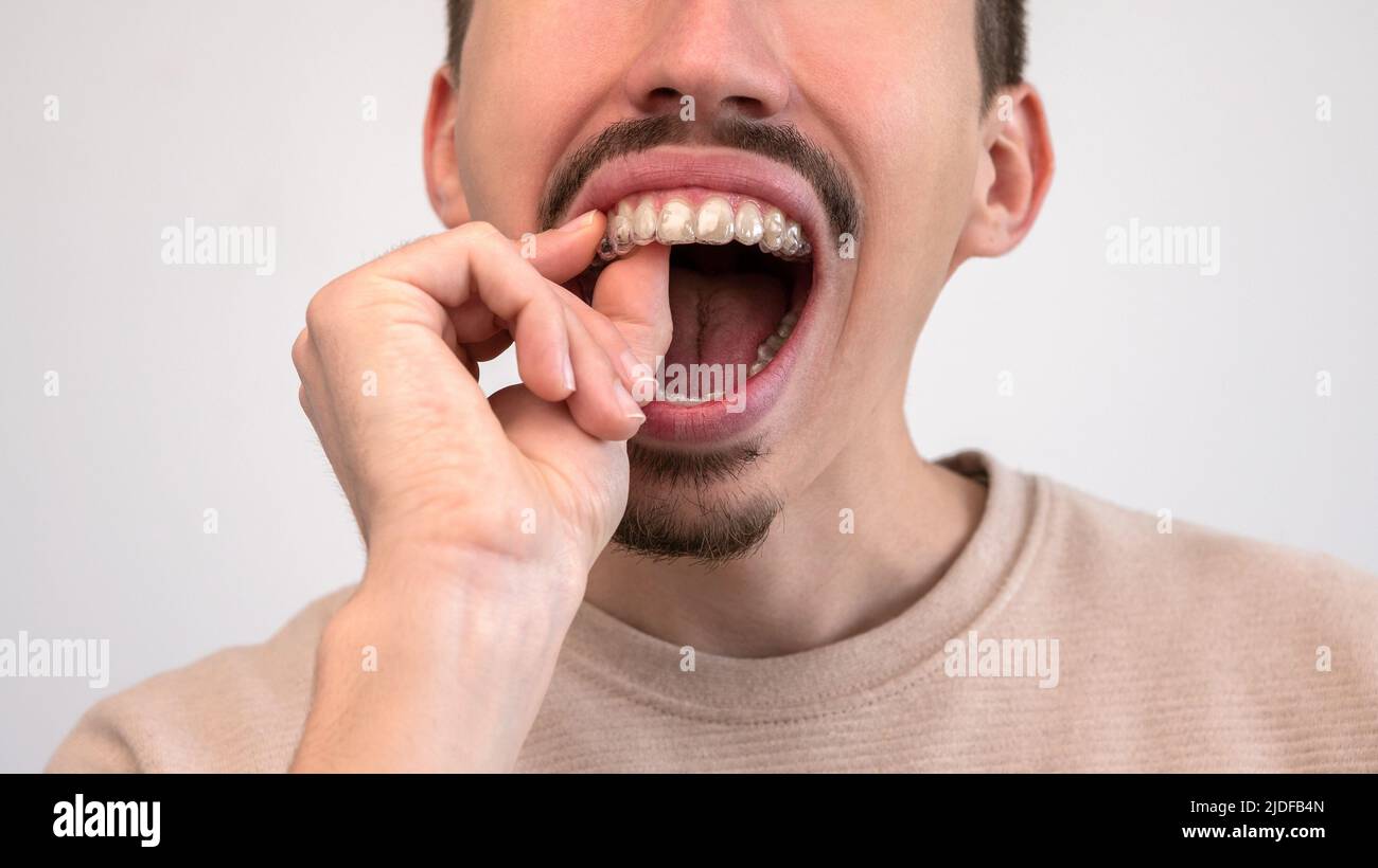 Caucasian young man adjusting and placing an invisible silicone aligner ...