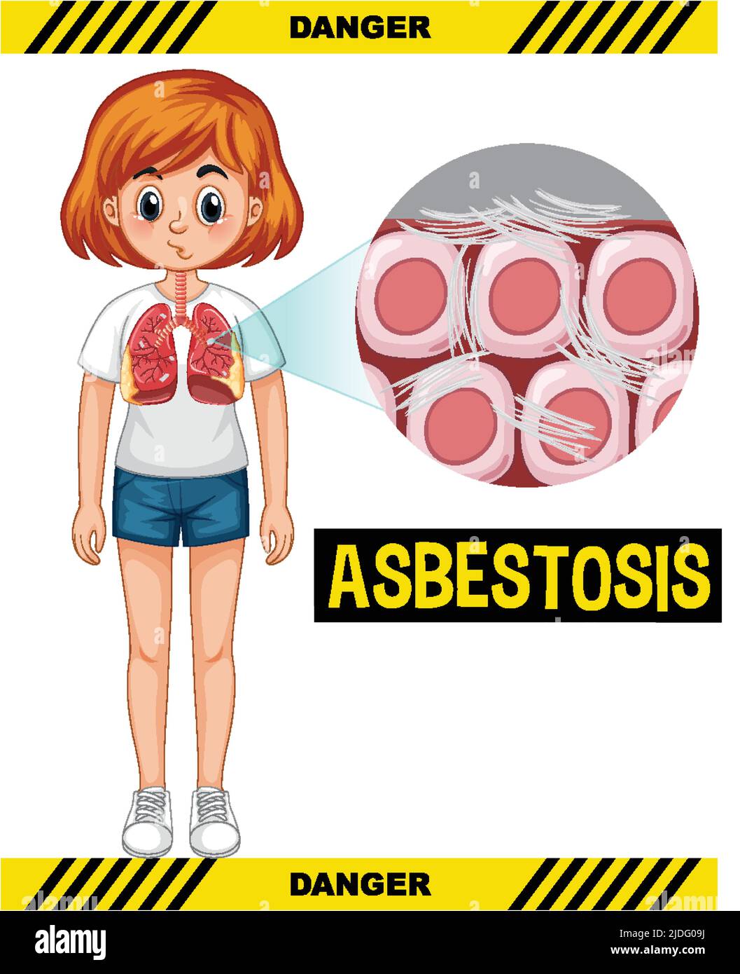 Diagram showing aspergillus infection illustration Stock Vector Image ...