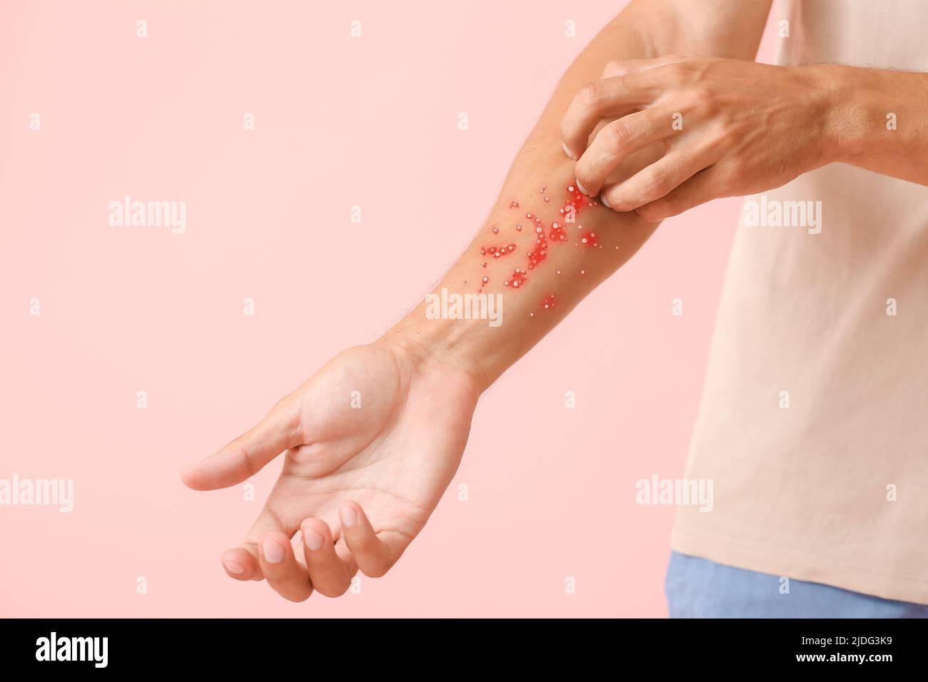 Monkeypox symptoms hi-res stock photography and images - Alamy