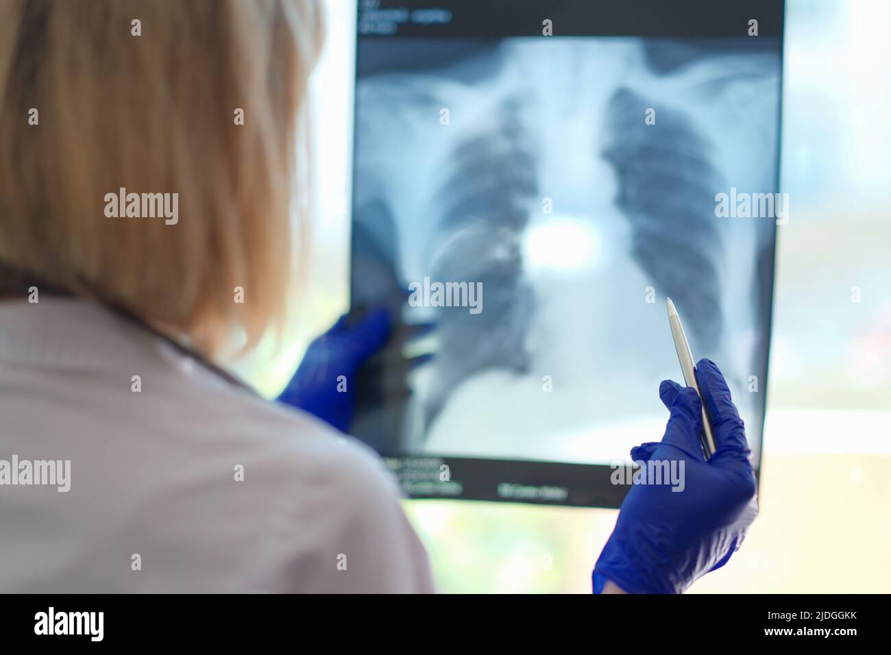 Radiologist looking at damaged area on lung x ray Stock Photo - Alamy