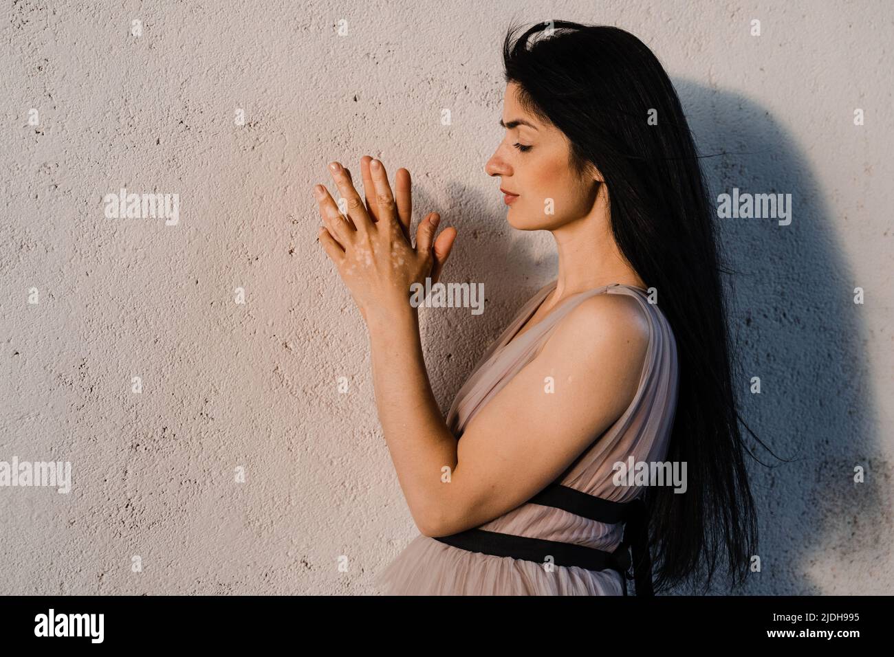 Vitiligo skin pigmentation on the hands of a beautiful Georgian woman ...