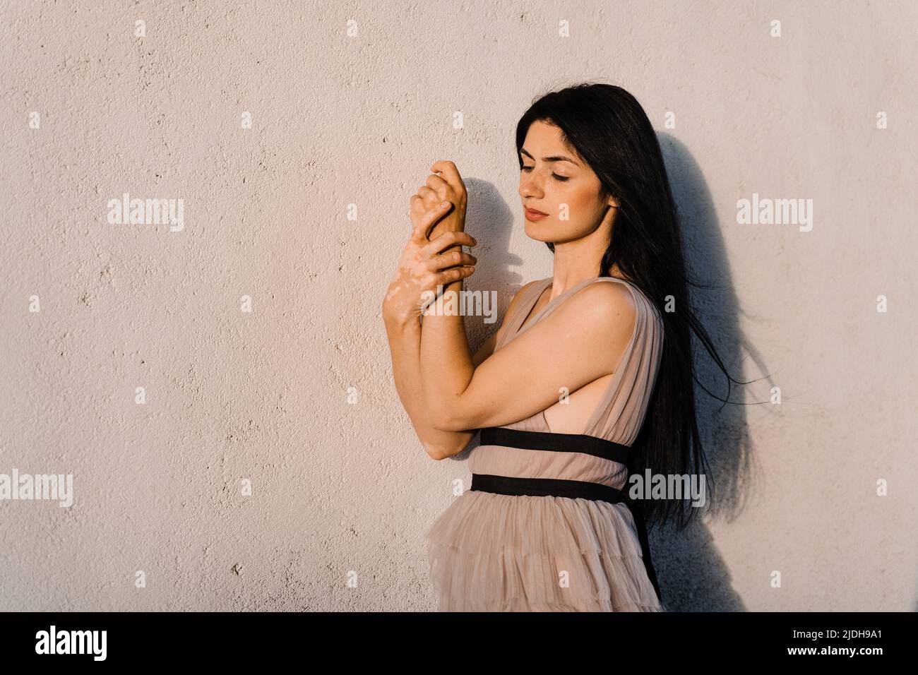 Vitiligo skin pigmentation on the hands of a beautiful Georgian woman ...