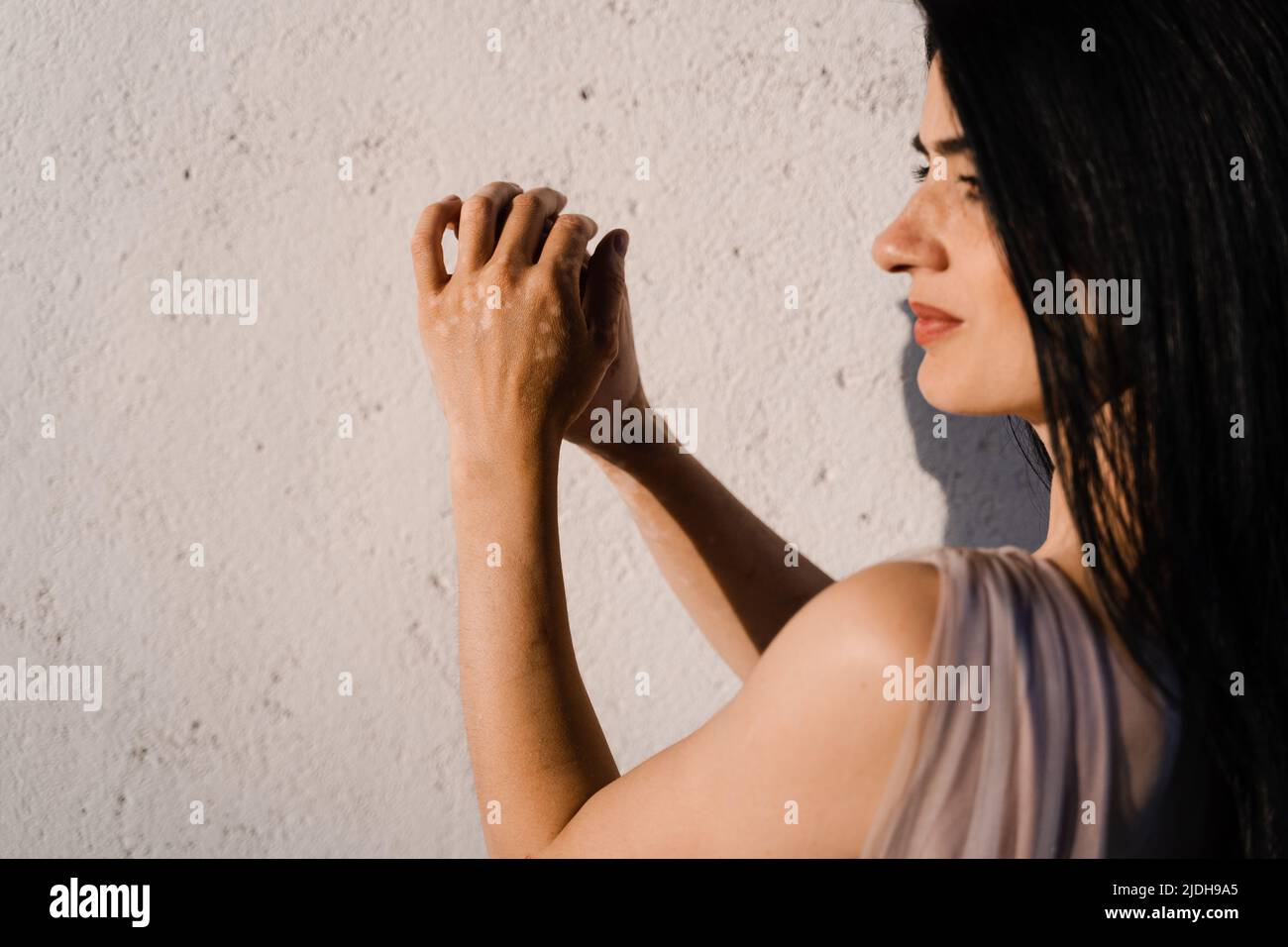 Vitiligo skin pigmentation on the hands of a beautiful Georgian woman ...