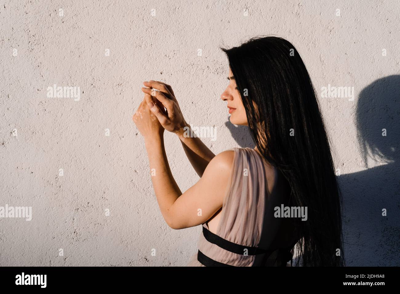 Vitiligo skin pigmentation on the hands of a beautiful Georgian woman ...