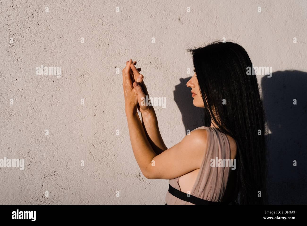 Vitiligo skin pigmentation on the hands of a beautiful Georgian woman ...