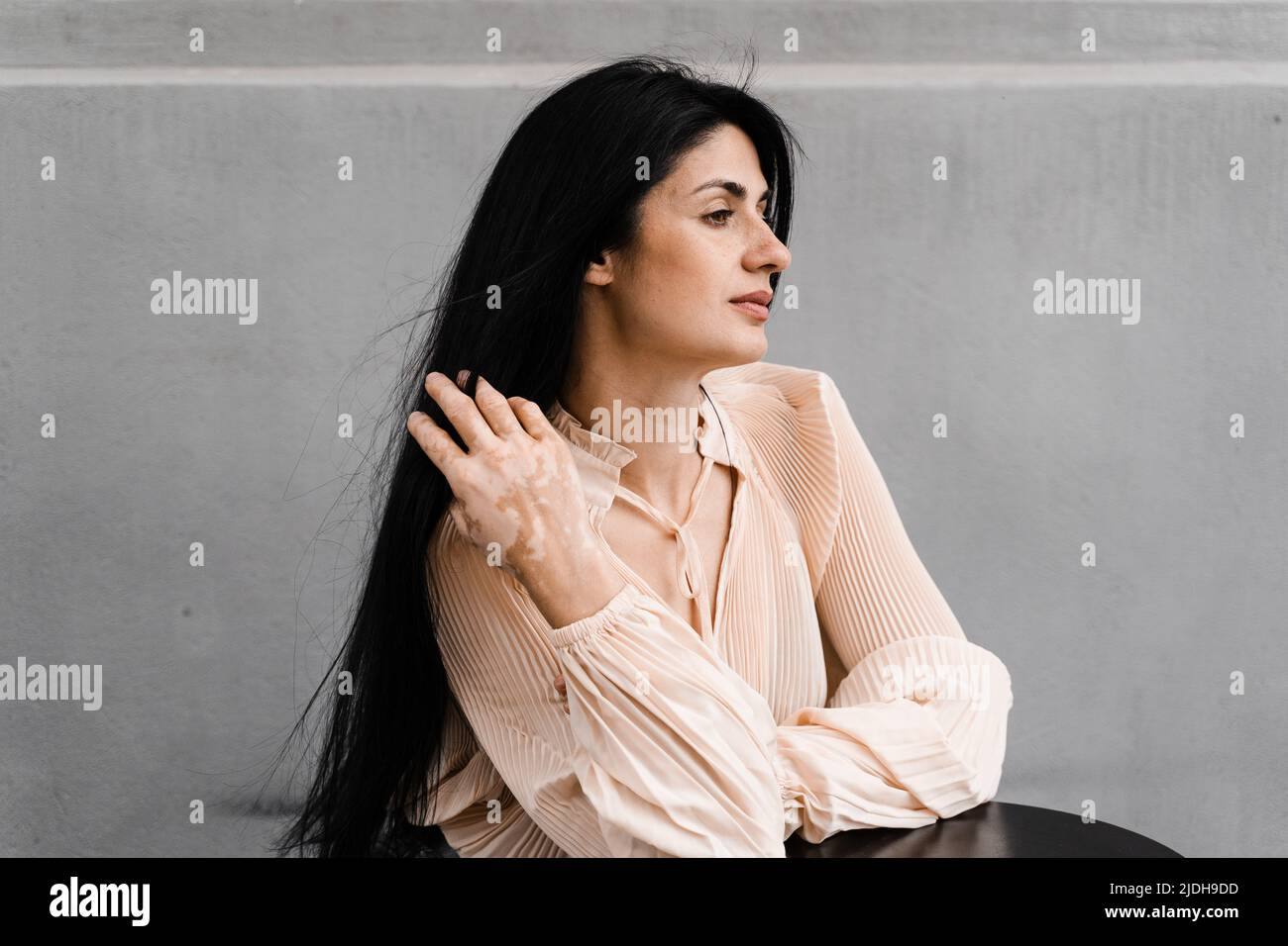 Attractive woman with vitiligo pigmentation patches on hands. Skin ...