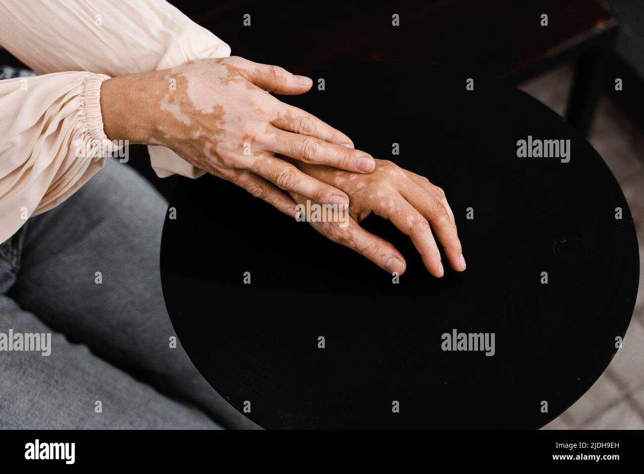 Hands with vitiligo skin pigmentation on black background close-up ...