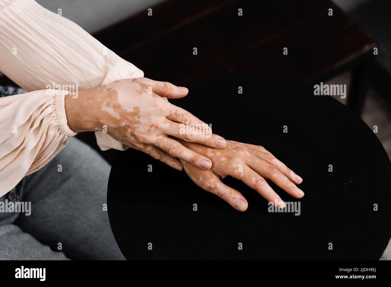 Hands with vitiligo skin pigmentation on black background close-up ...