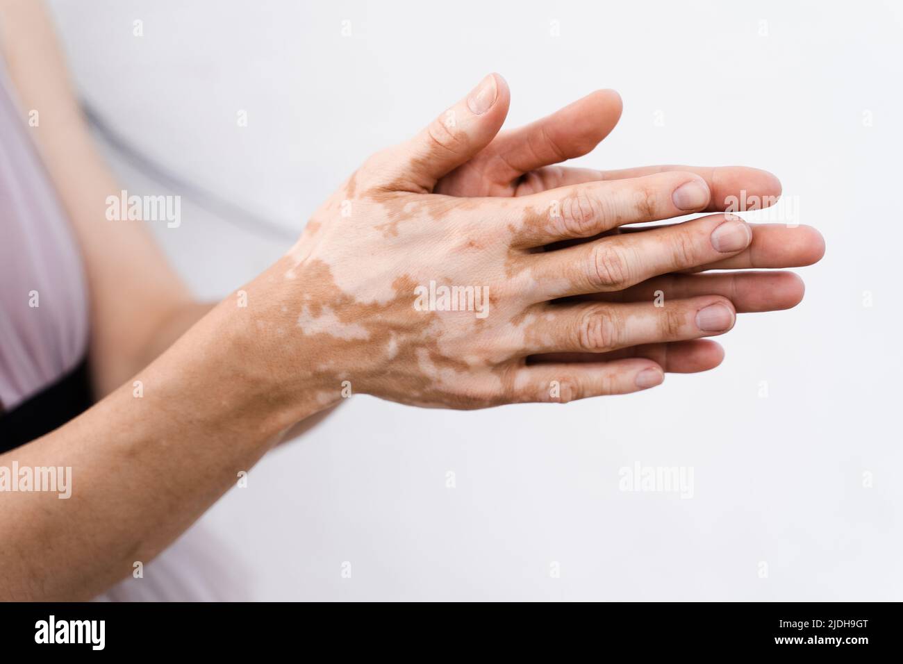 Hands with vitiligo skin pigmentation on white background close-up ...