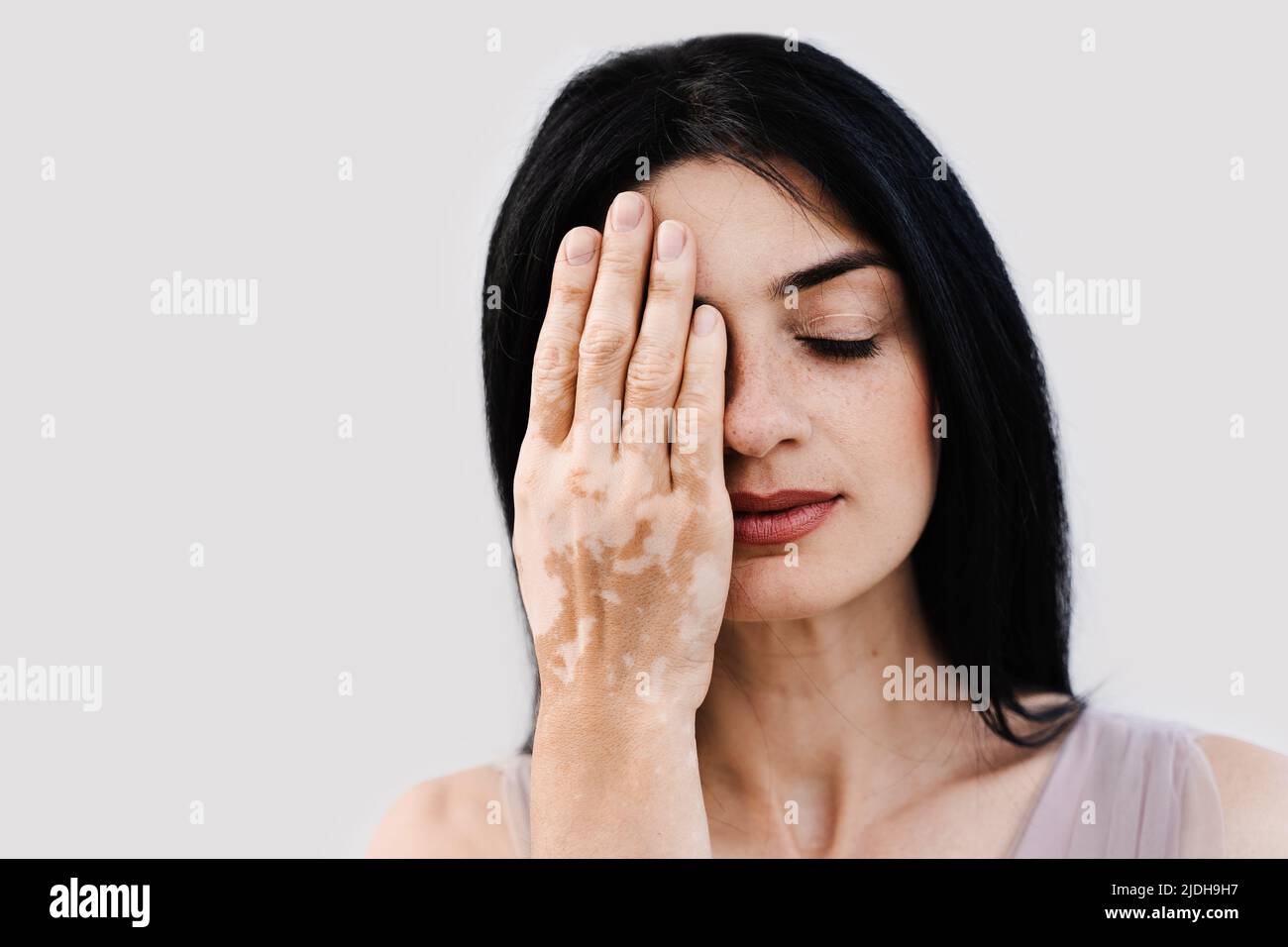 Georgian woman with vitiligo pigmentation patches on hands covers her ...