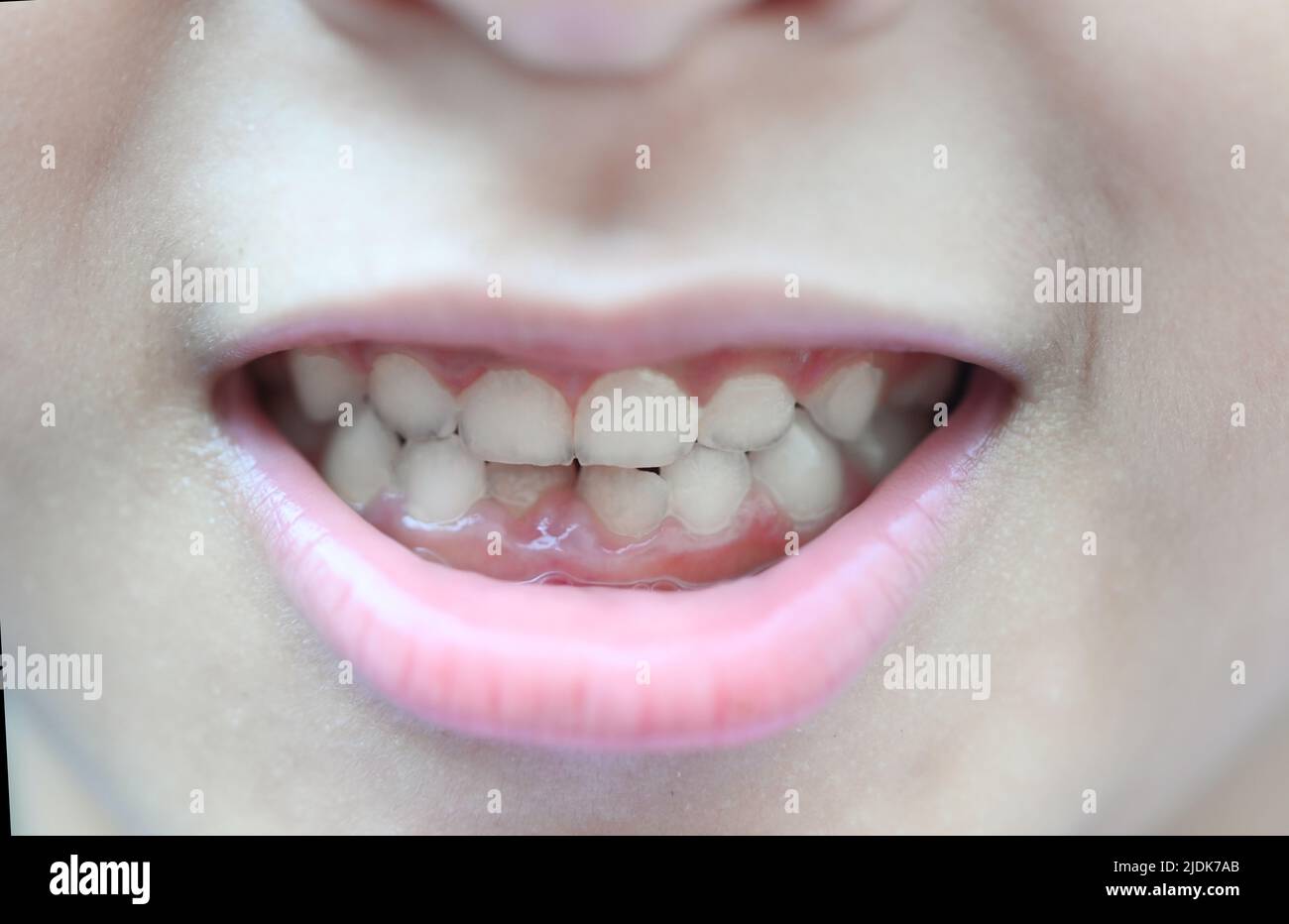Milk tooth , Closeup baby teeth of tooth loss , the girl child teeth ...