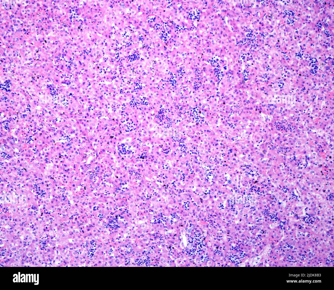 Erythroblastosis fetalis, light micrograph Stock Photo - Alamy