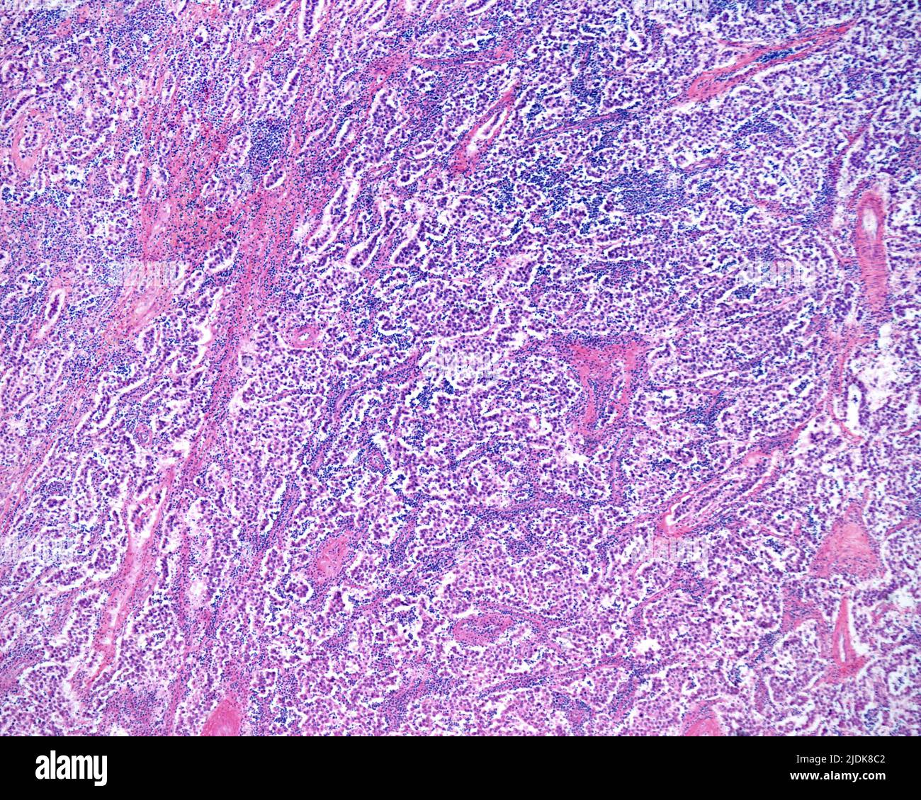 Testicle cancer, light micrograph Stock Photo - Alamy