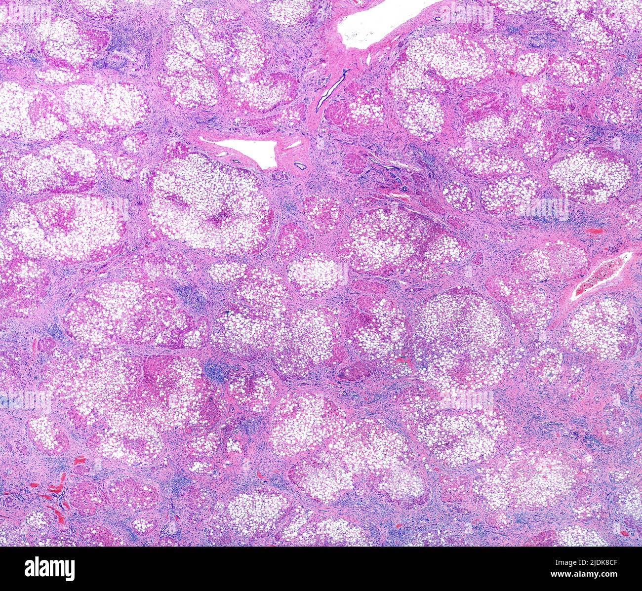 Cirrhosis and steatosis of the liver, light micrograph Stock Photo - Alamy