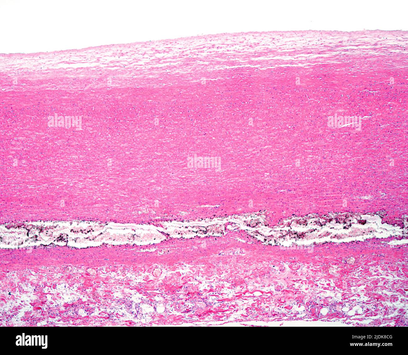 Dissecting aneurysm, light micrograph Stock Photo - Alamy