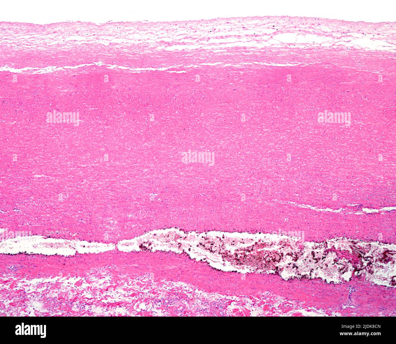 Dissecting aneurysm, light micrograph Stock Photo - Alamy