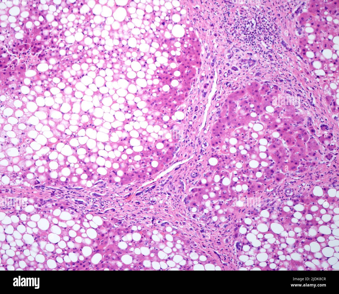 Cirrhosis and steatosis of the liver, light micrograph Stock Photo - Alamy