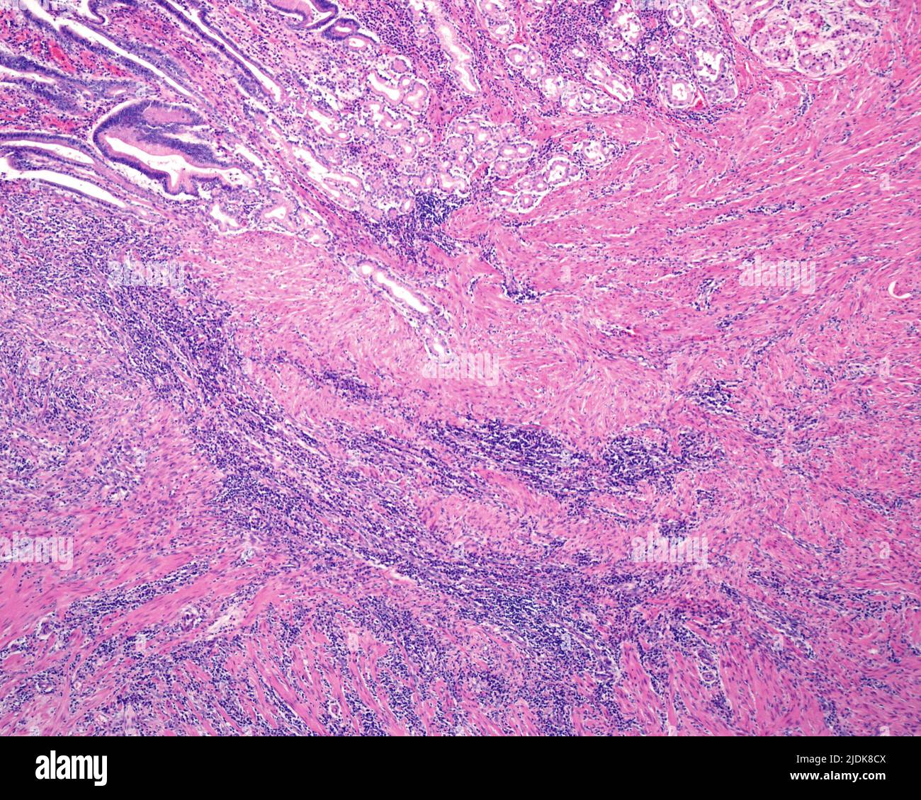 Peptic ulcer, light micrograph Stock Photo - Alamy