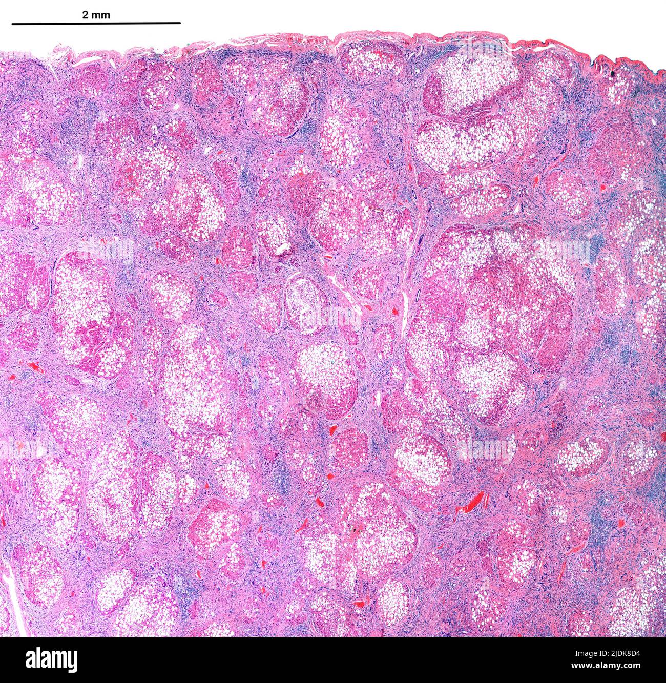 Cirrhosis and steatosis of the liver, light micrograph Stock Photo - Alamy
