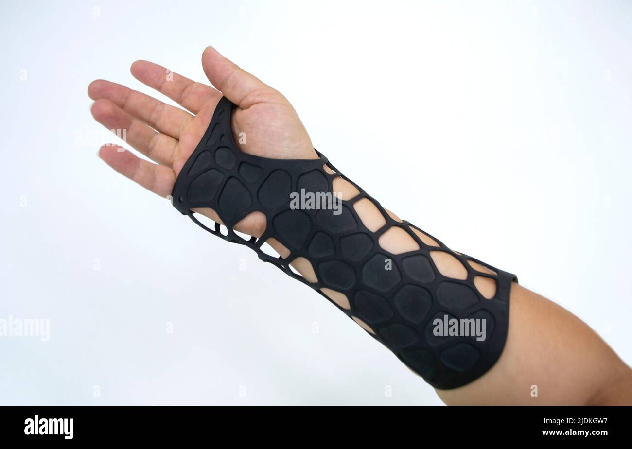 Orthopedic plastic prosthesis printed on powder 3D printer on hand ...