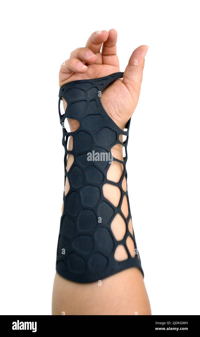 Orthopedic plastic prosthesis printed on powder 3D printer on hand ...