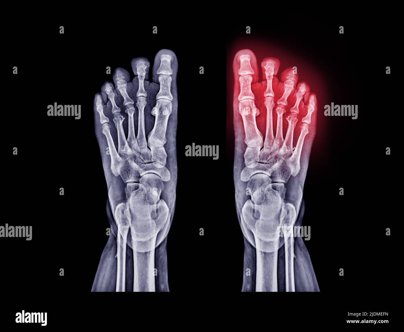 Bone deformity toe hi-res stock photography and images - Alamy