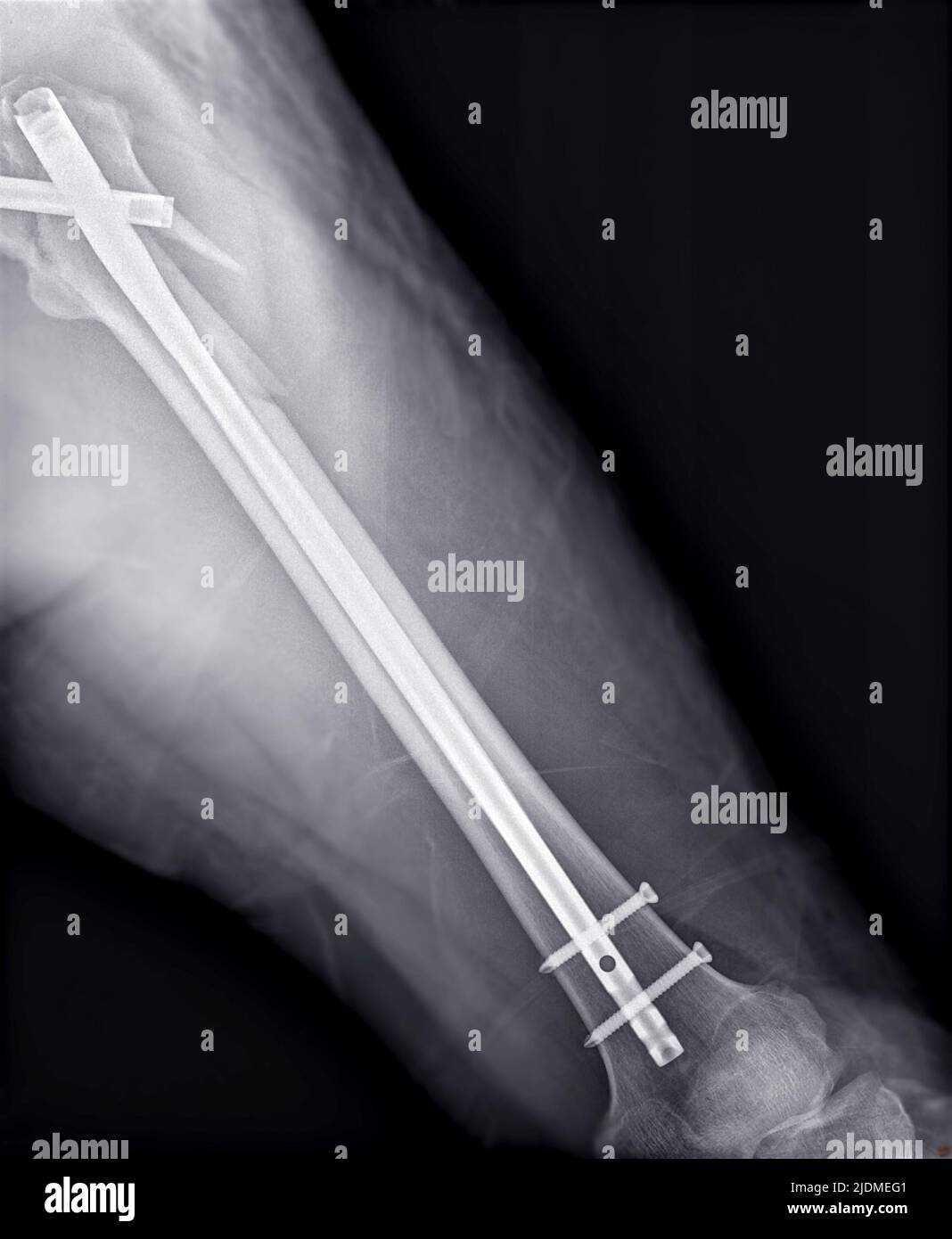 Joint replacement operation hi-res stock photography and images - Alamy