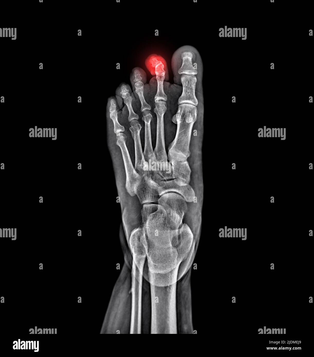 Foot x-ray image showing dislocation of toe isolated on black ...