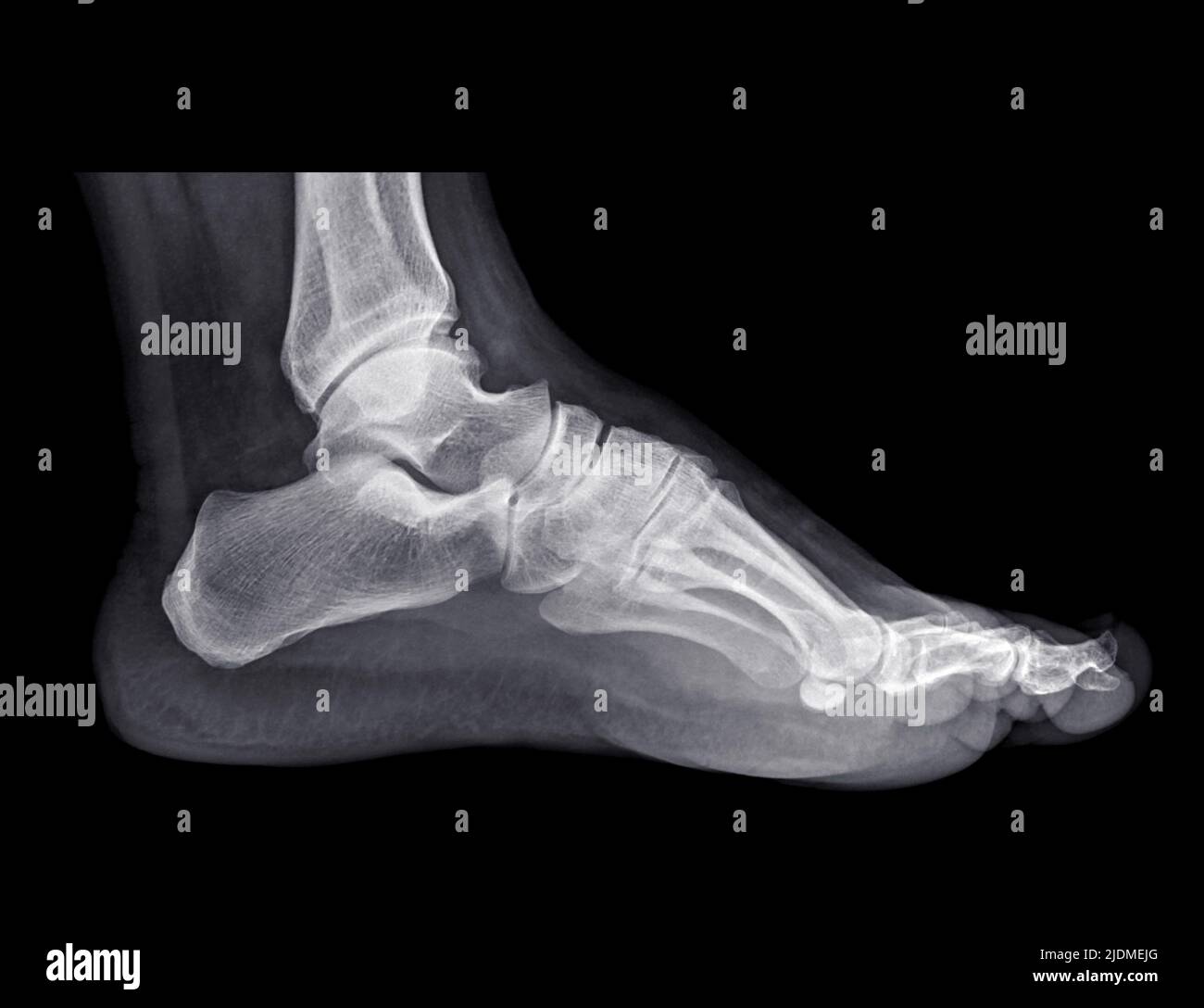 Foot x-ray image on isolated on black background Stock Photo - Alamy