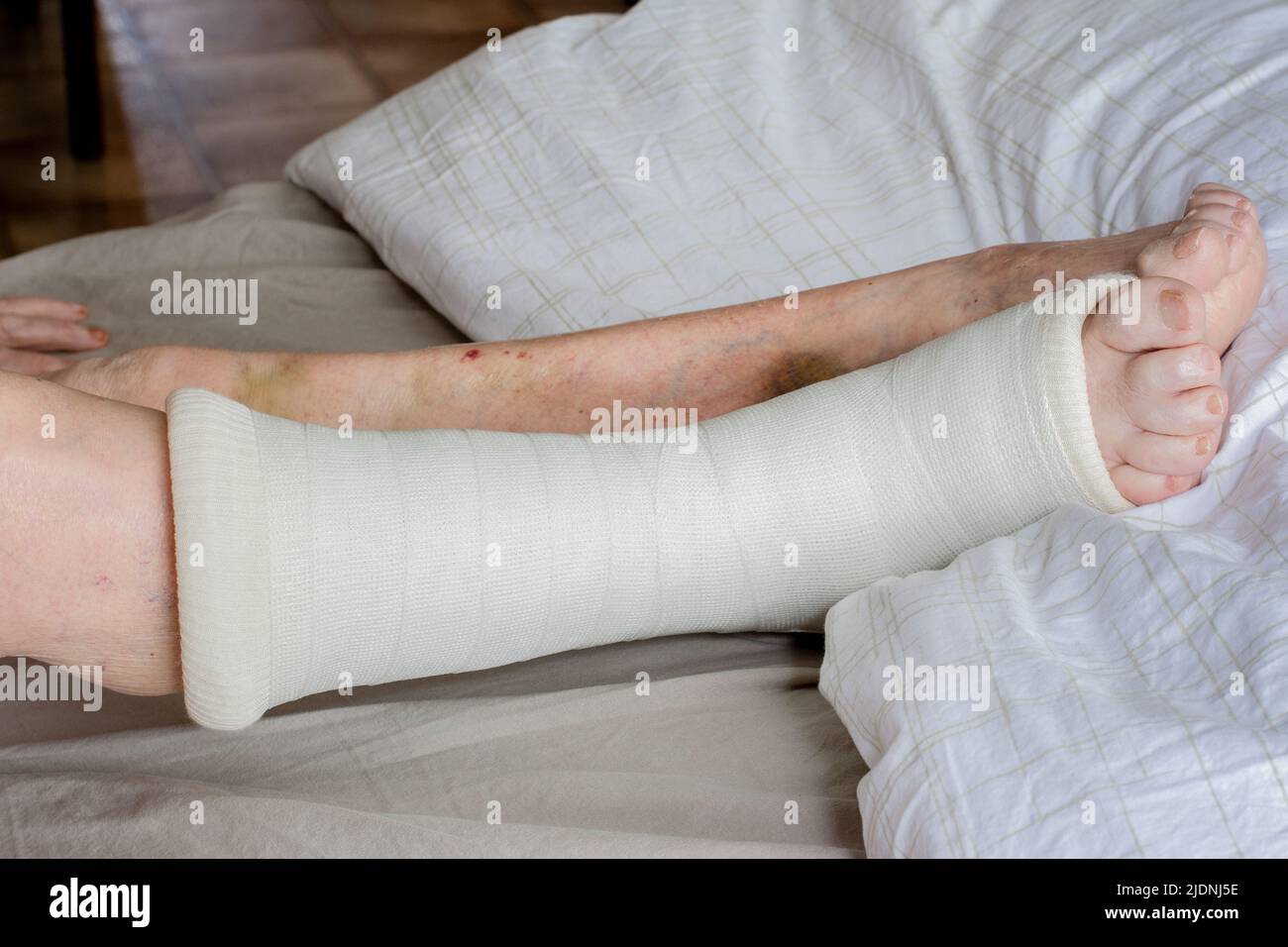 Cast ankle on an elderly person Fracture of the malleolus Stock Photo ...