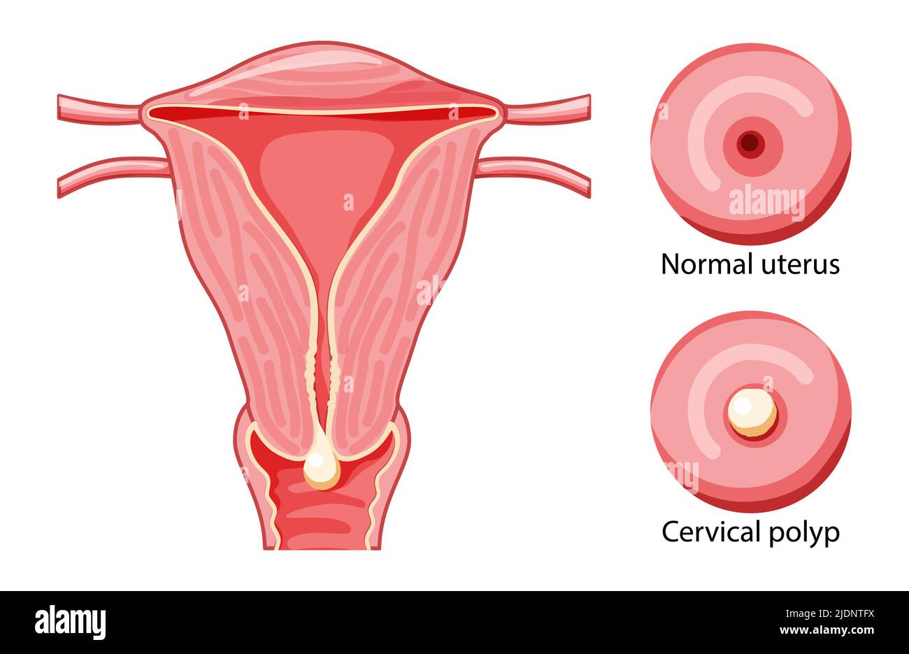 Set Of Cervical Polyp In The Uterus Female Reproductive System In Cross Section And Cervix View