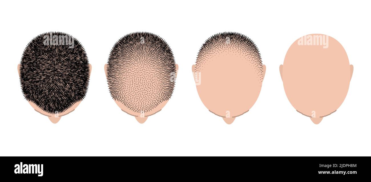 Hair loss bald head alopecia transplant growth vector top view. Hair ...