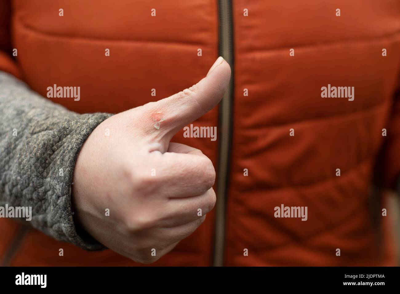 Man's hand with wound on his skin. Damaged finger. Skin came off my arm ...