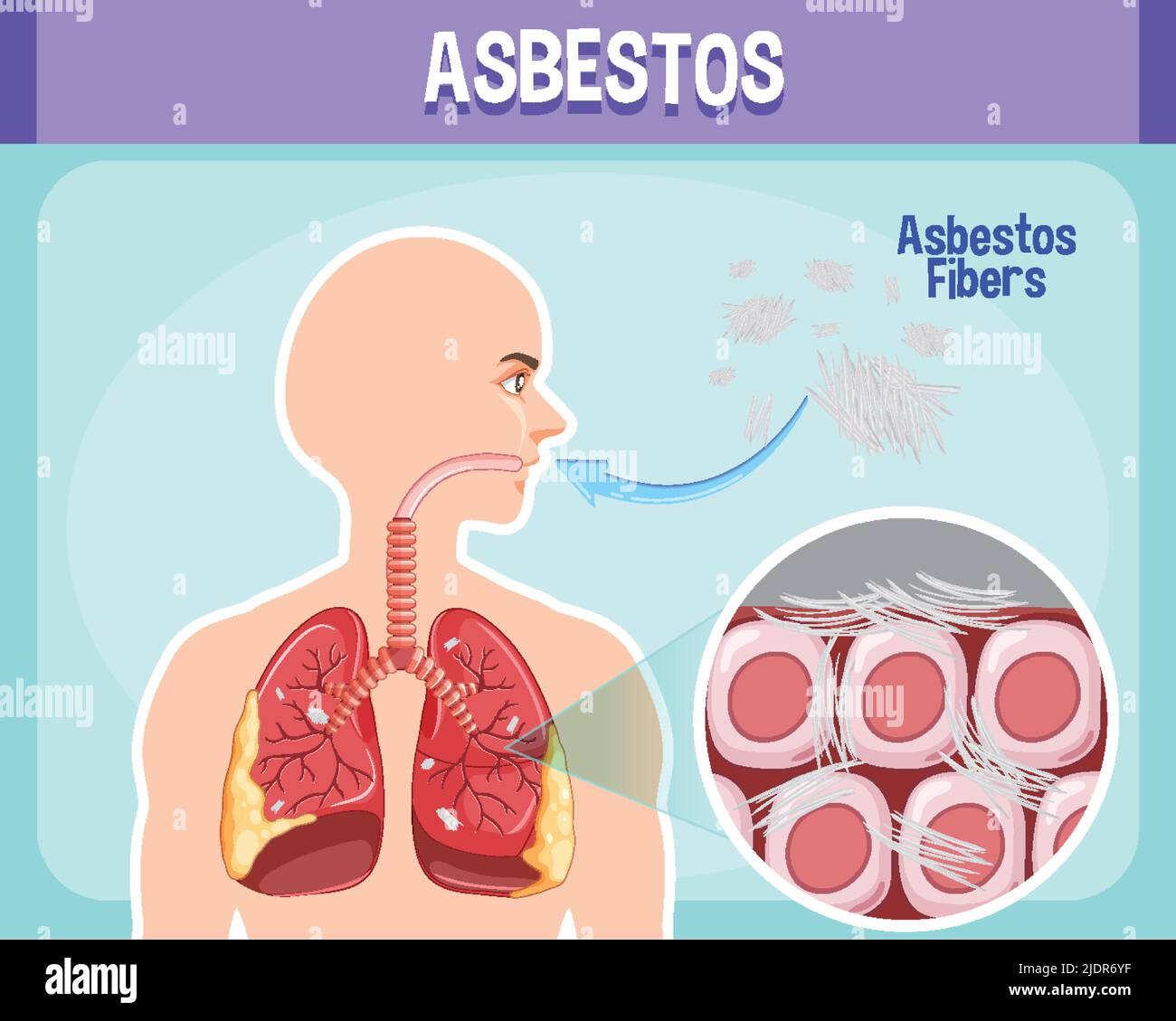 Diagram showing asbestosis in lungs illustration Stock Vector Image ...