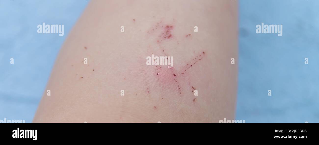 Scratches on a child's leg. Selective focus Stock Photo - Alamy