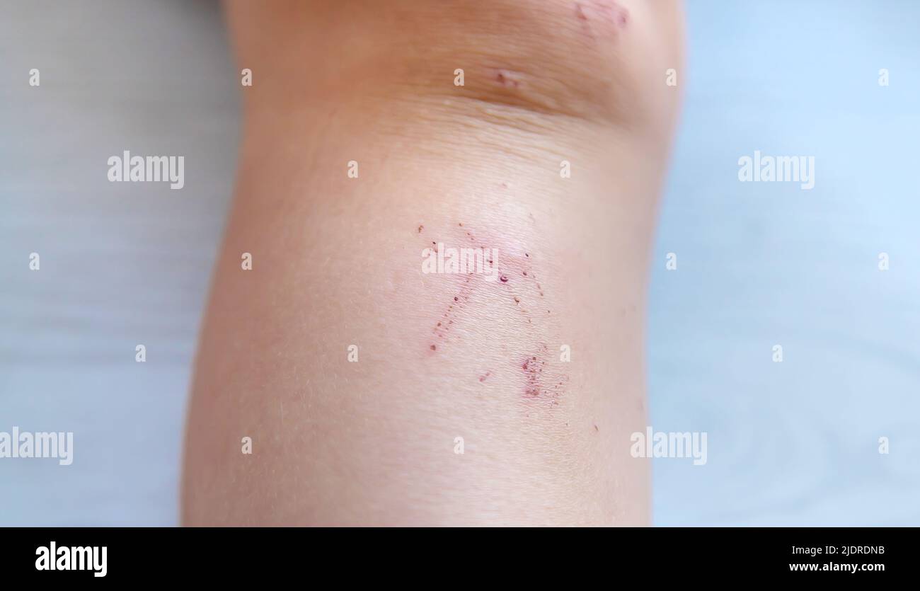 Scratches on a child's leg. Selective focus Stock Photo - Alamy