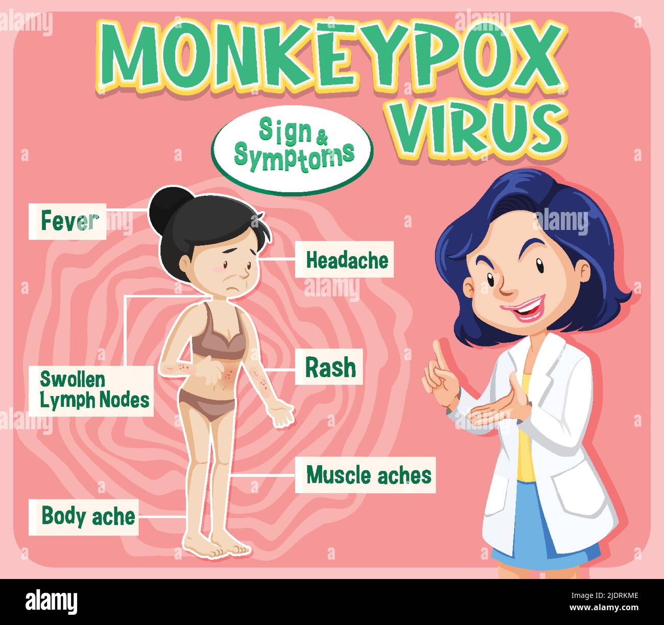 Monkeypox virus sign and symptoms infographic illustration Stock Vector ...