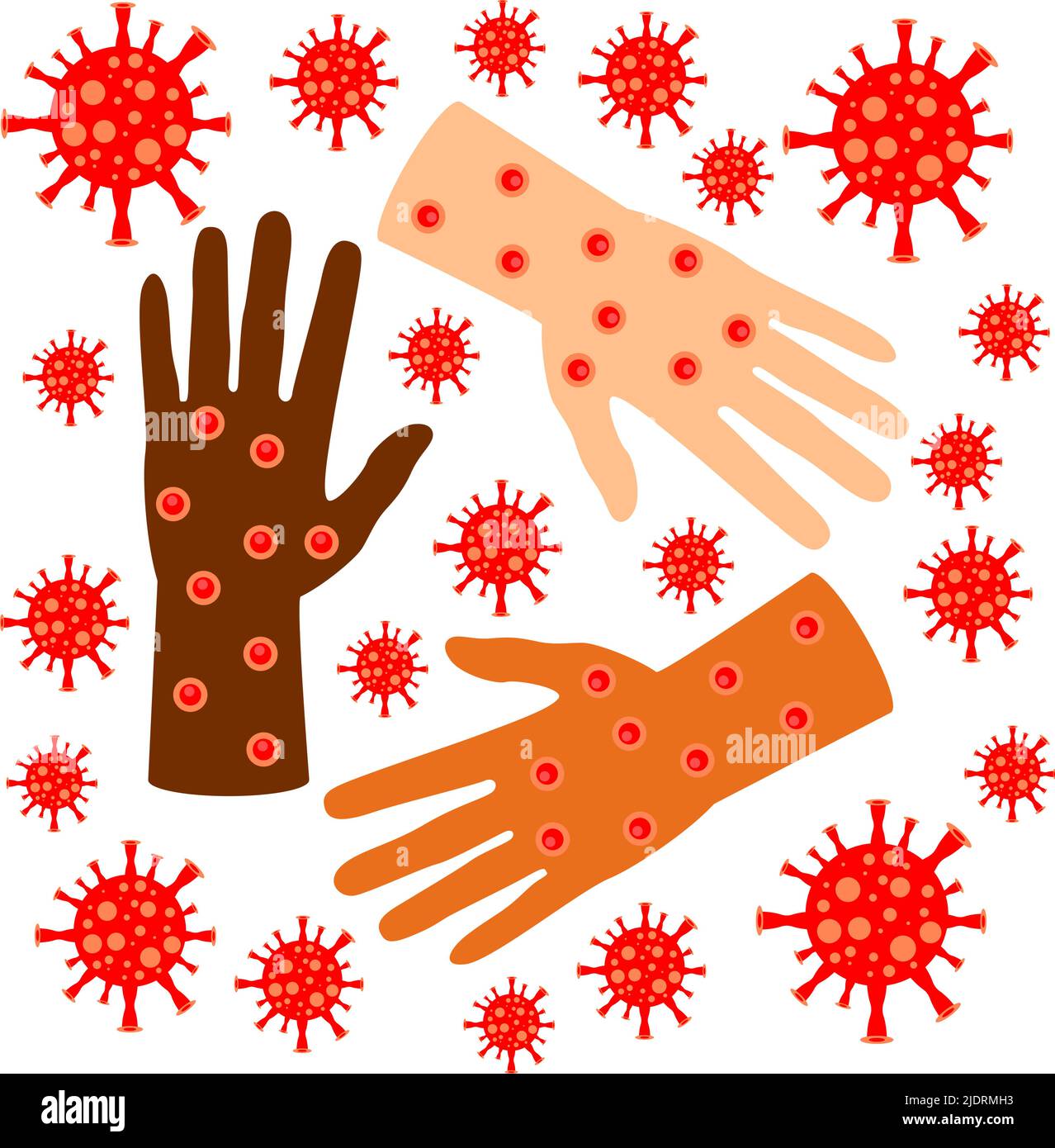 Monkeypox virus, Three human hands of different skin colors in smallpox ...