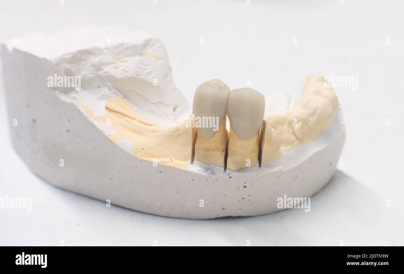 Artificial teeth are made of ceramics for the patient Stock Photo - Alamy